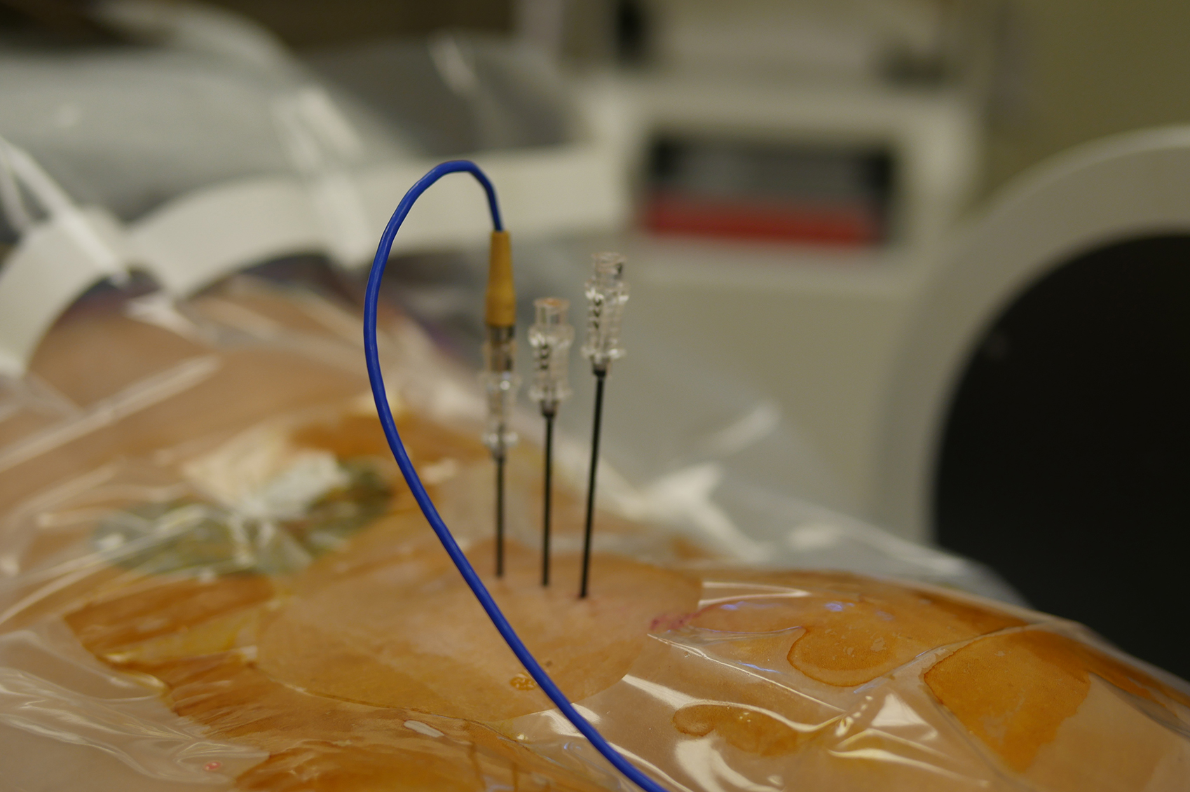 Radiofrequency Ablation Nuerotomy Arch Advanced Pain Management Radiofrequency Ablation Nuerotomy Arch Advanced Pain Management
