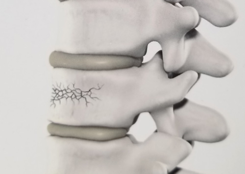Compression Fractures | Arch Advanced Pain Management
